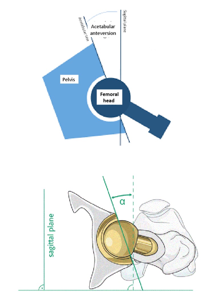 Acetabular Anteversion: Femoral Head | PDF
