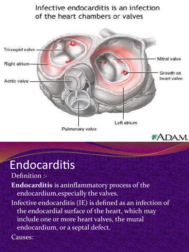 Endocarditis | PDF | Epidemiology | Heart