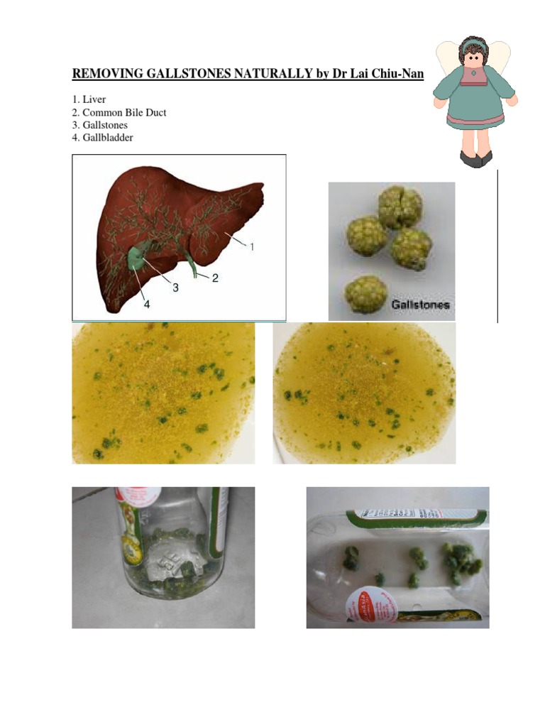 Gallstones - Remove Naturally | PDF