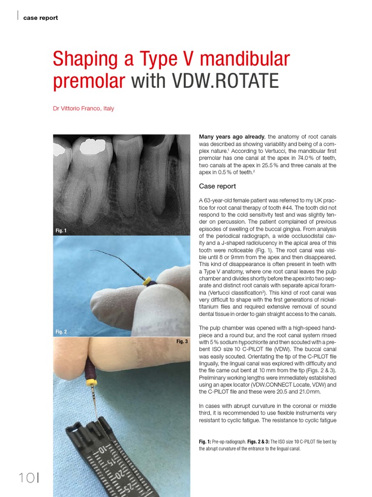 Shaping A Type V Mandibular Premolar: With VDW - ROTATE | PDF | Dentistry Branches | Dentistry