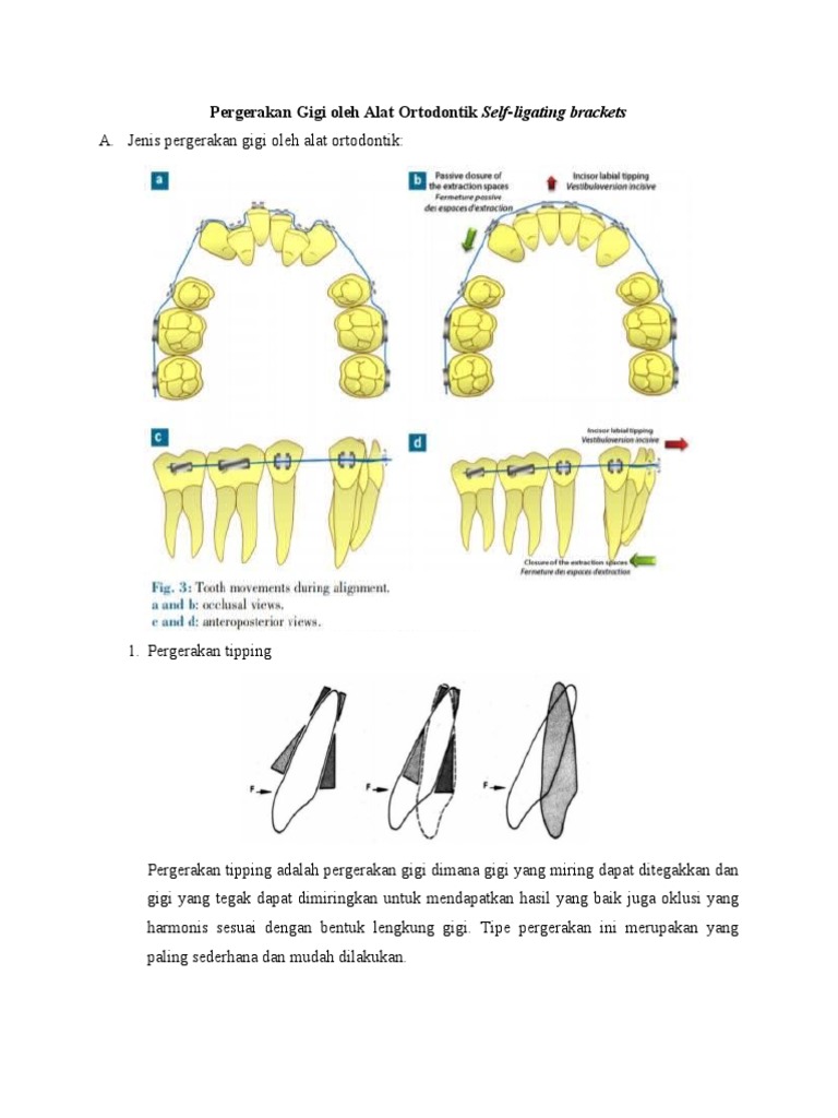PERGERAKAN GIGI DENGAN SELF-LIGATING BRACKETS | PDF