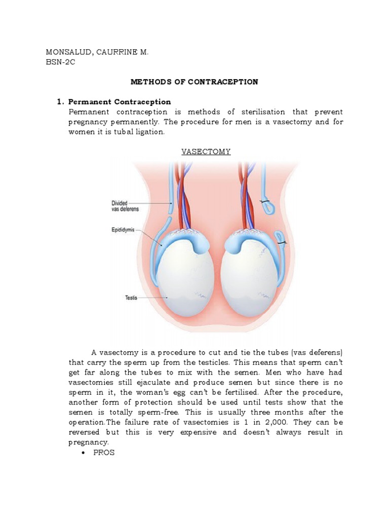 Methods of Contraception 1. Permanent Contraception | PDF | Birth Control | Sexual Health