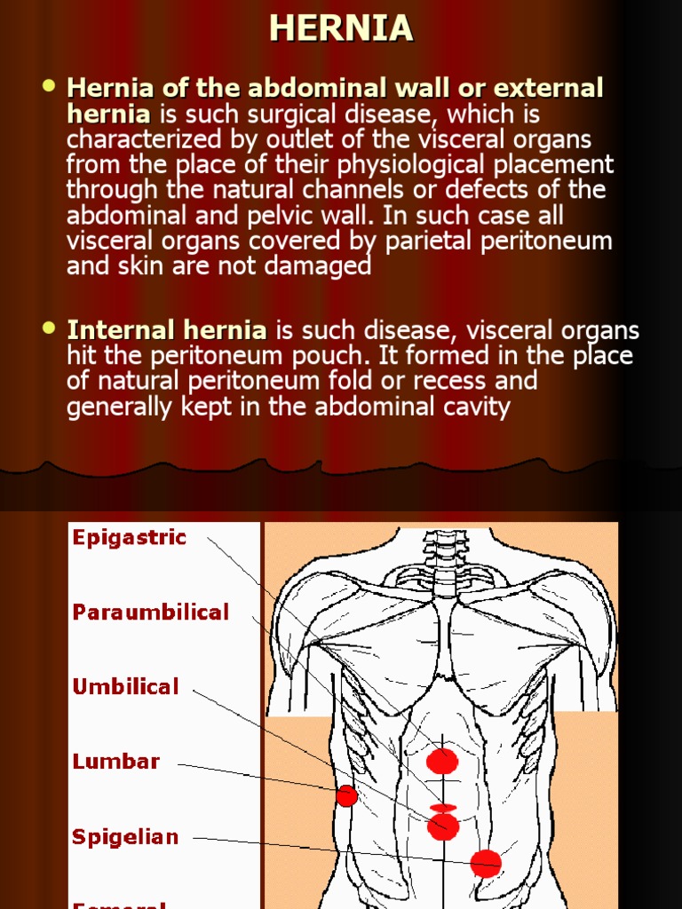 LEC 15.1 - Abdominal Hernias | PDF | Abdomen | Medicine