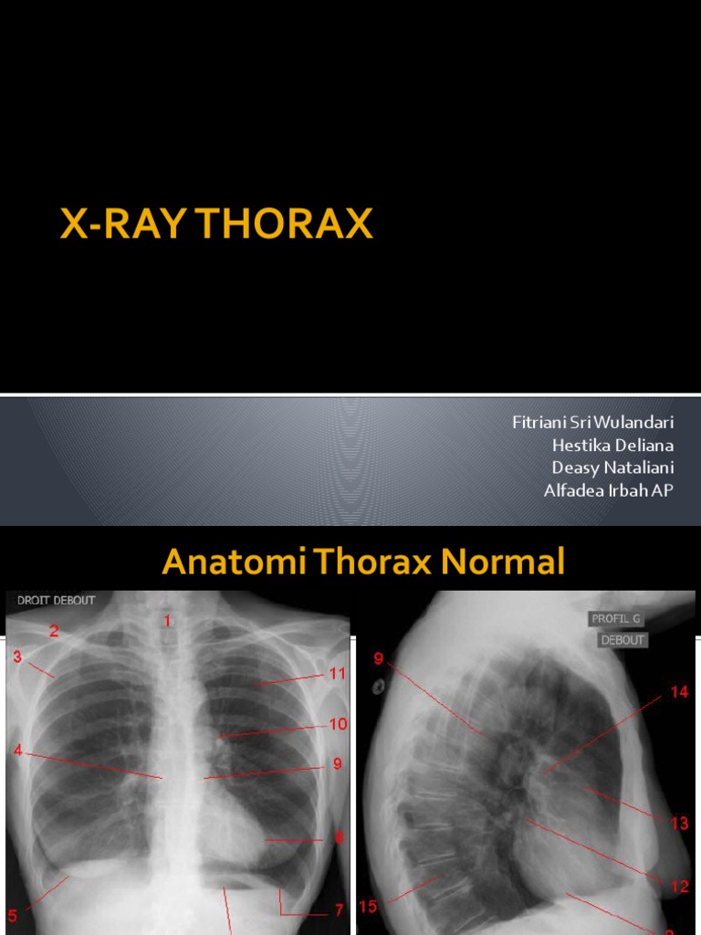 X-Ray Thorax | PDF
