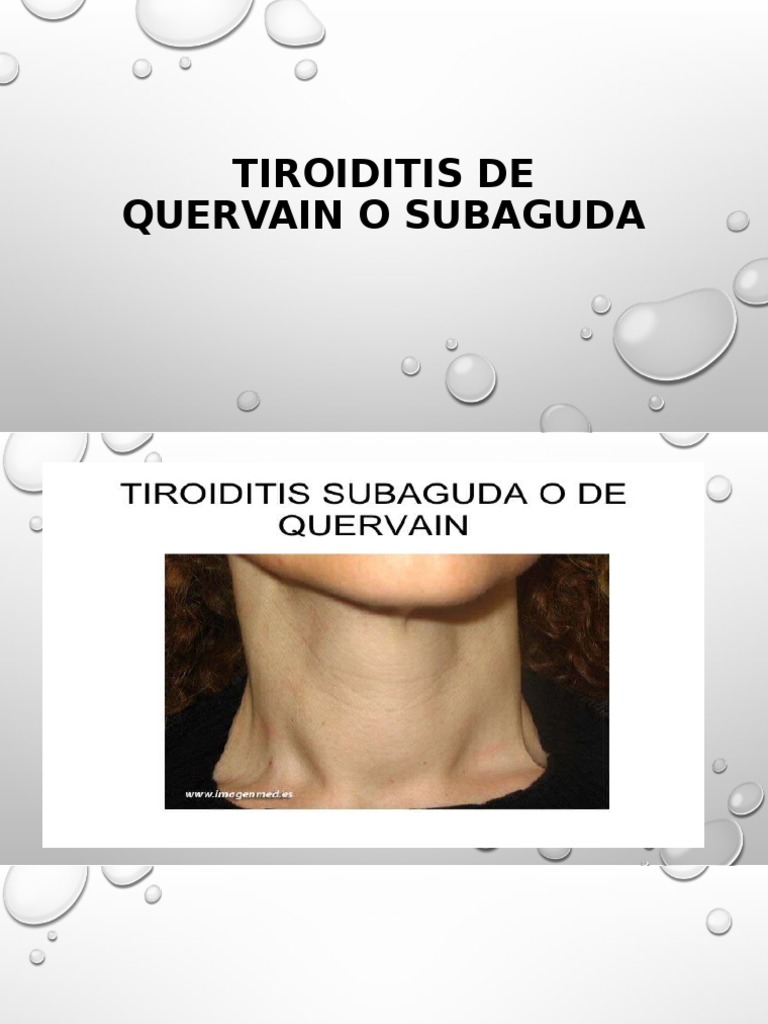 Tiroiditis Subaguda o de Quervain | PDF | Tiroides | Hipertiroidismo