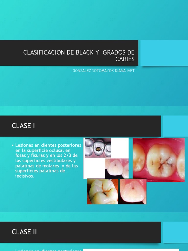 Clasificacion de Black y Grados de La Caries | PDF