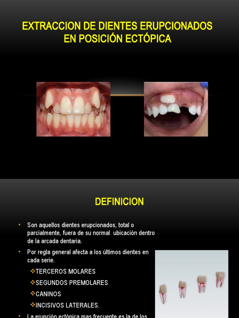 Extraccion de Dientes Erupcionados en Posición Ectópica | PDF | Diente ...