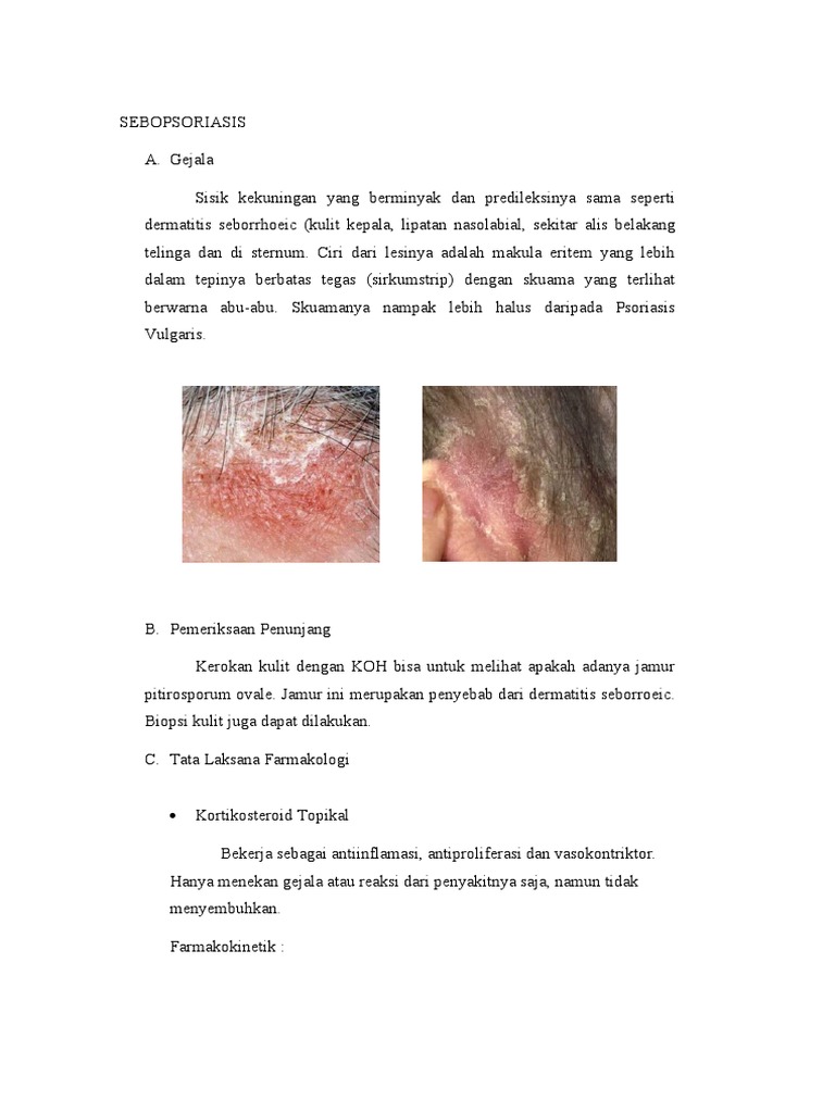 Sebopsoriasis Bagian Gejala Sampai Pencegahan | PDF | Kesehatan ...