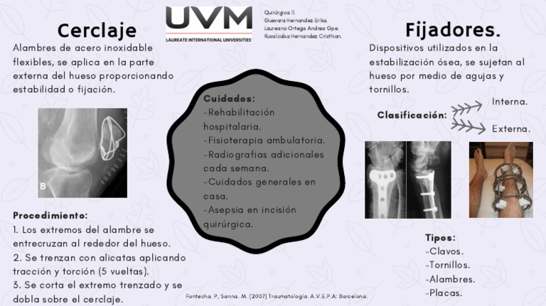 Cerclaje y fijadores en estabilización ósea | PDF | Cirugía