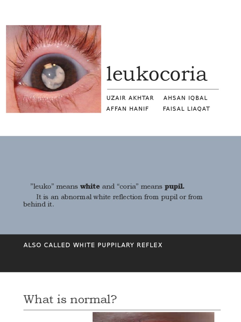Leukocoria: Uzair Akhtar Ahsan Iqbal Affan Hanif Faisal Liaqat | PDF