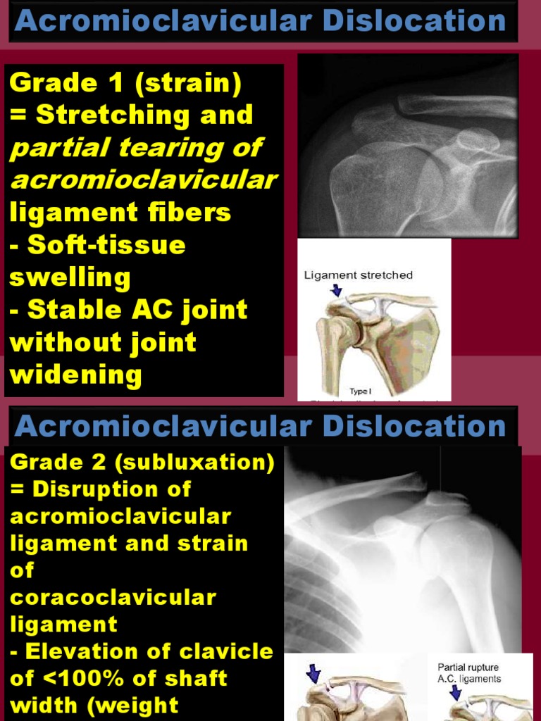 Grade 1 (Strain) Stretching and Ligament Fibers - Soft-Tissue Swelling ...