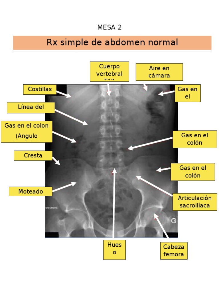 RX Simple de Abdomen Normal: Mesa 2 | PDF | Abdomen | Intestino grueso
