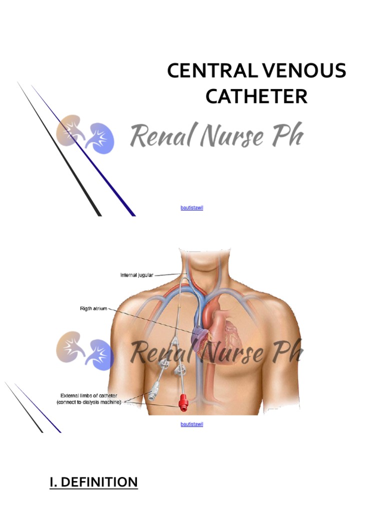An Overview of Central Venous Catheters for Hemodialysis: Types ...