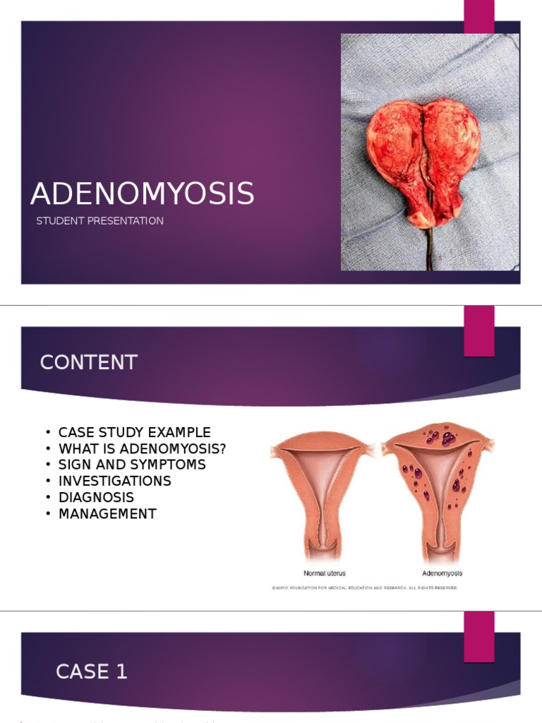 ADENOMYOSIS | PDF | Female Mammals | Gynaecology