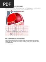 Delta Wave - LITFL Medical Blog - ECG Library Basics | PDF | Cardiac ...