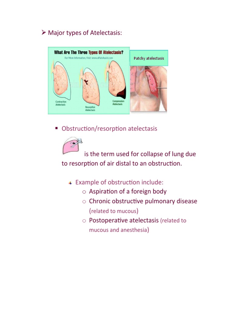 Major Types of Atelectasis | PDF