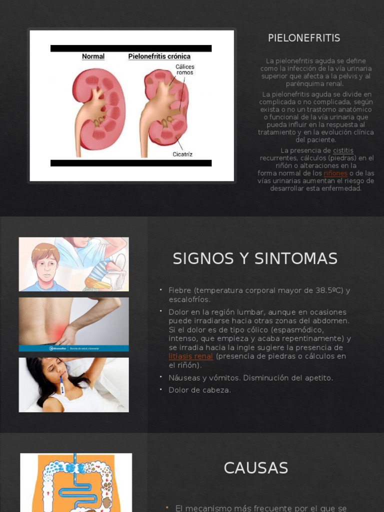 PIELONEFRITIS | PDF | Especialidades Medicas | Medicina CLINICA
