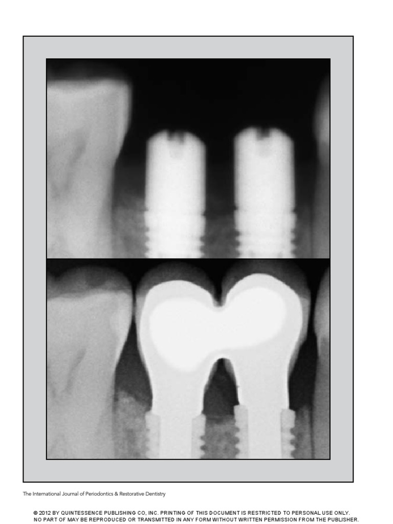 Crestal Bone Changes On Platform - Switched Implants and Adjacent Teeth ...