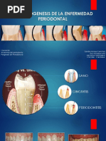 Estadios y Grados de La Periodontitis | PDF