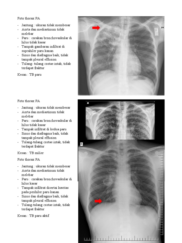 Foto Thorax Radiologi | PDF