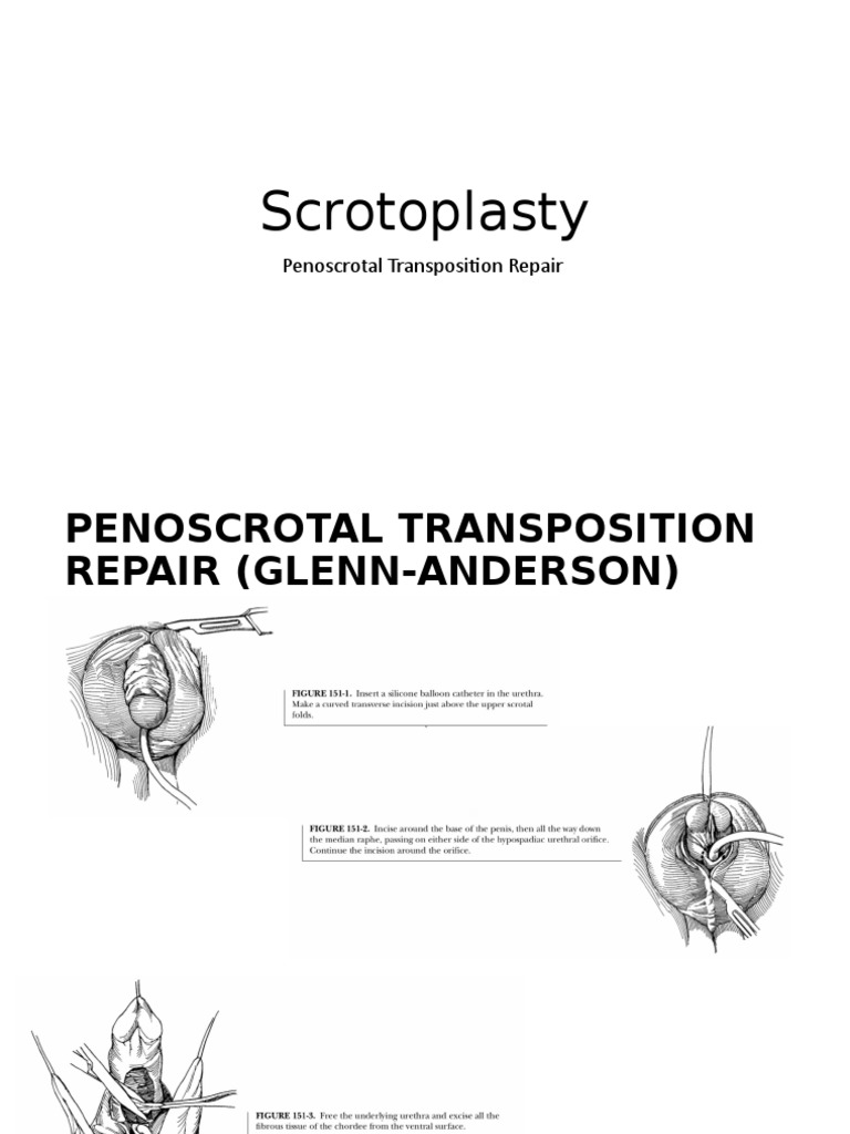 Scrotoplasty: Penoscrotal Transposition Repair | PDF