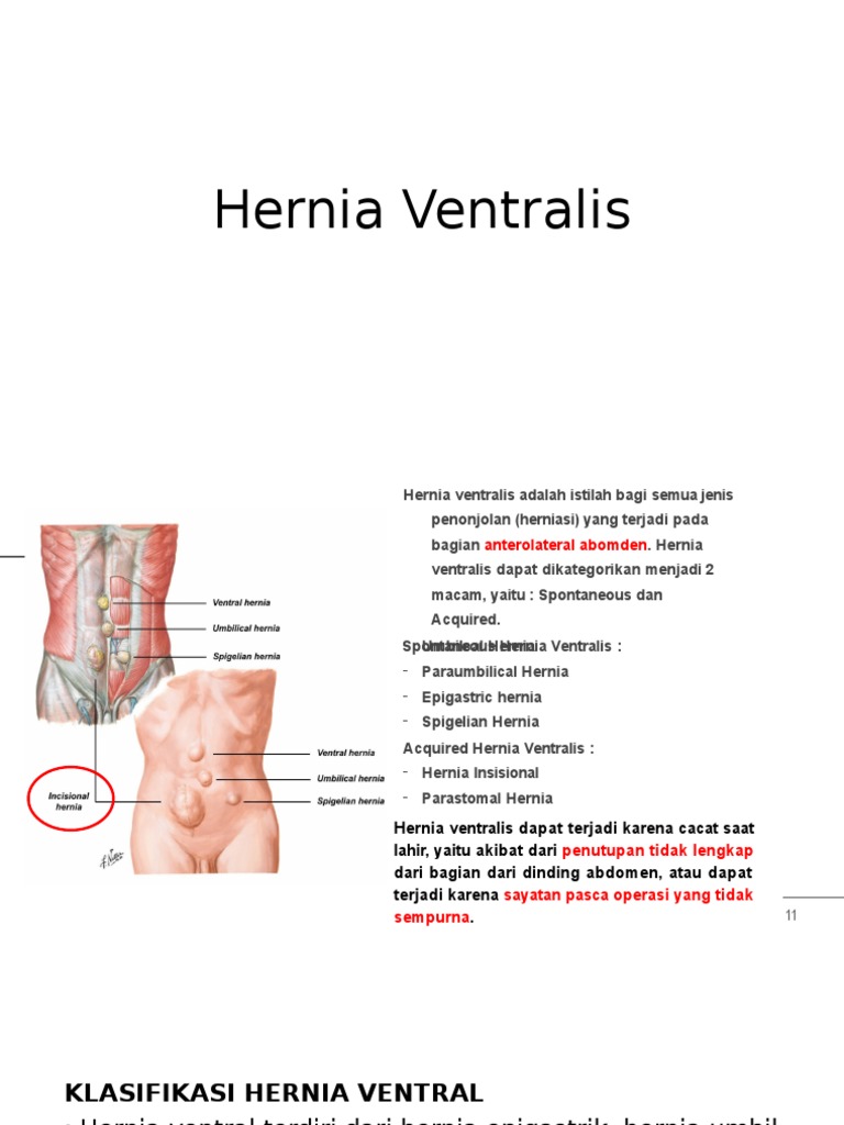Hernia Ventralis | PDF