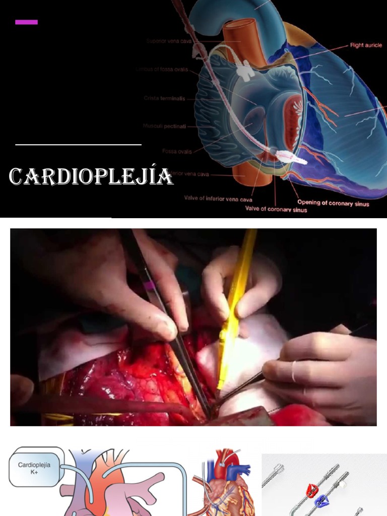 Cardioplejia | PDF | Vena | Músculo cardíaco