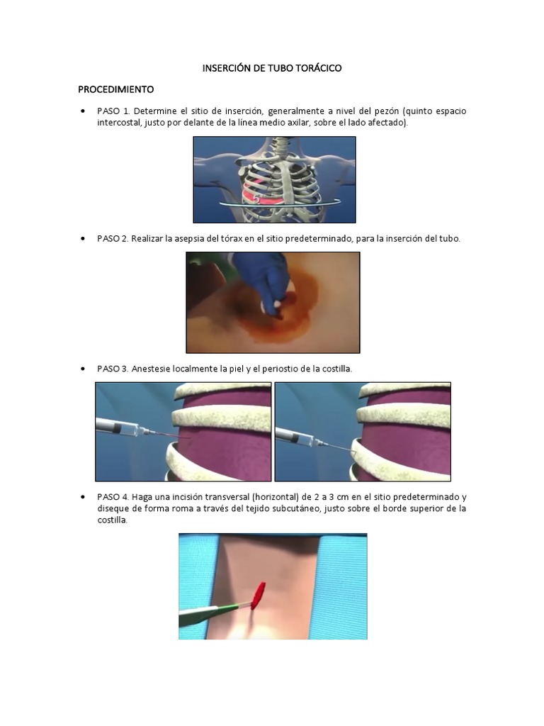 Inserción de Tubo Torácico | PDF