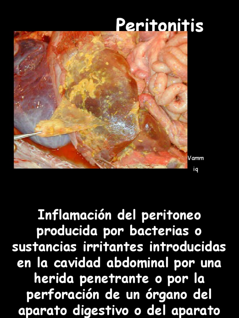 Clasificación y Tratamiento de Peritonitis | PDF | Enfermedades y ...