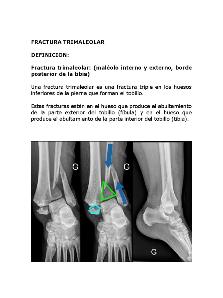 Fractura Trimaleolar de Tobillo: Guía Clínica | PDF | Tobillo | Sistema ...