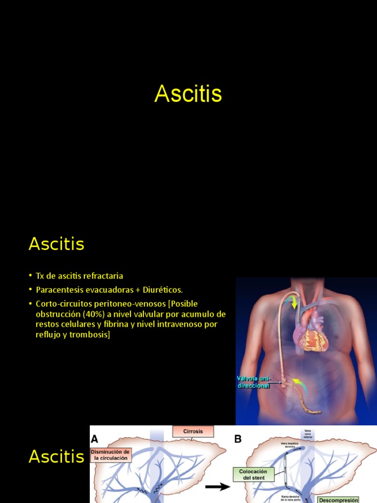 Ascitis | PDF | Las bacterias | Epidemiología