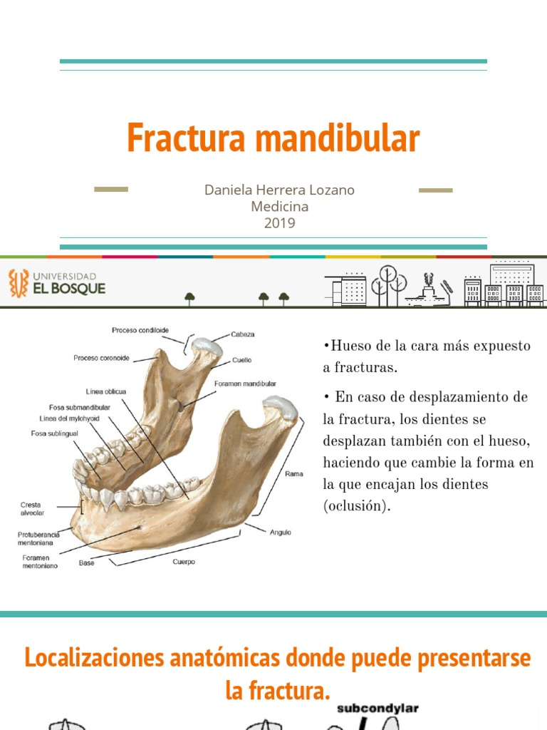 Fractura Mandibular. | PDF | Odontología | Sistema musculoesquelético