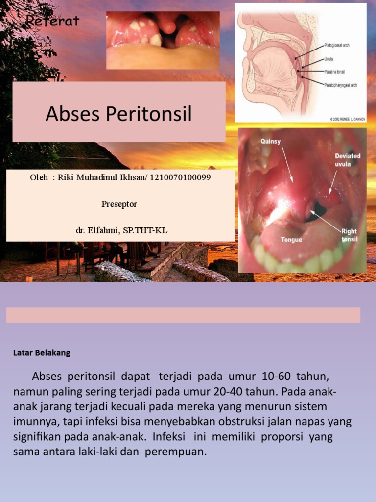 Panduan Abses Peritonsil | PDF