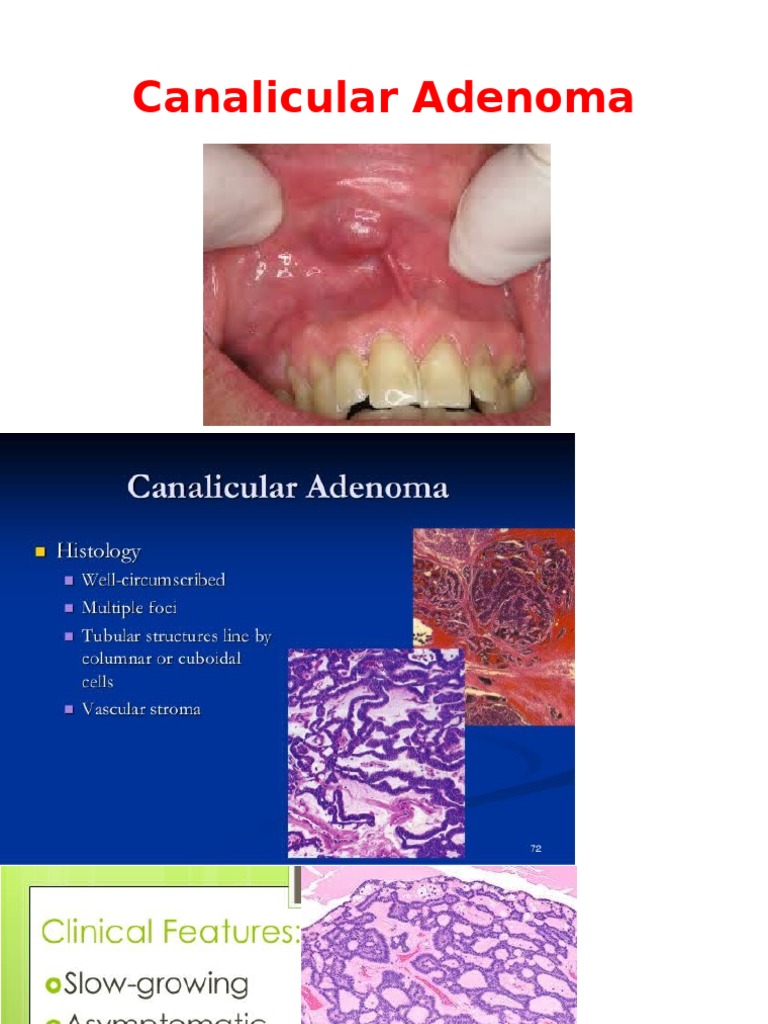 4 Canalicular Adenoma | PDF