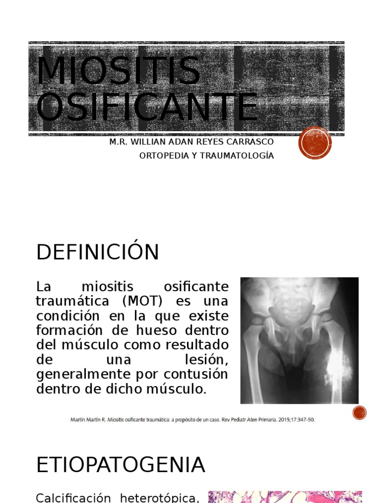Miositis Osificante | PDF | Hueso | Anatomía
