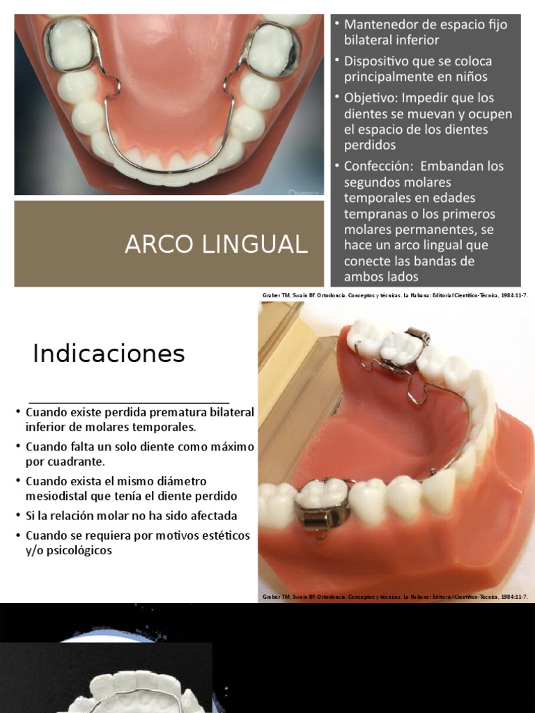 Arco Lingual | PDF | Ortodoncia | Boca