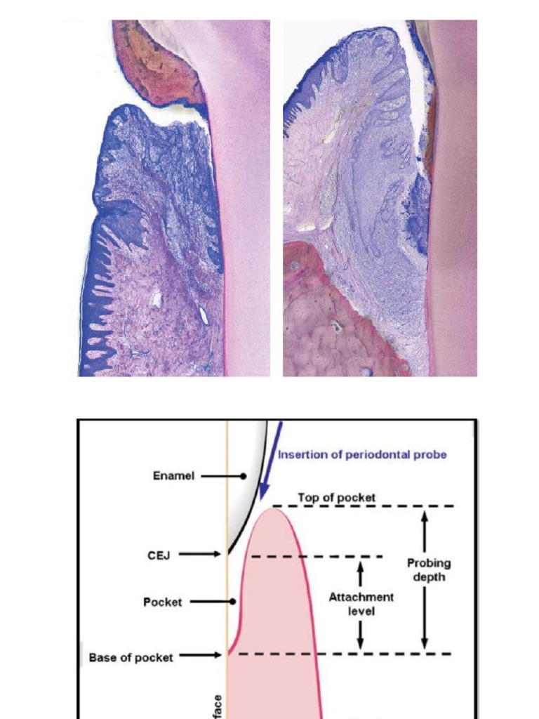The Peridontal Pocket | PDF | Periodontology | Human Tooth