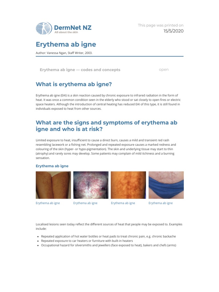 Erythema Ab Igne - DermNet NZ | PDF | Clinical Medicine | Dermatology