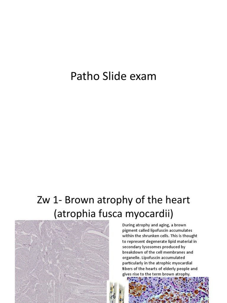 Patho Slides | PDF | Adenocarcinoma | Epithelium
