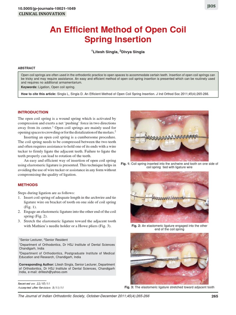 An Efficient Method of Open Coil Spring Insertion | PDF | Orthodontics ...
