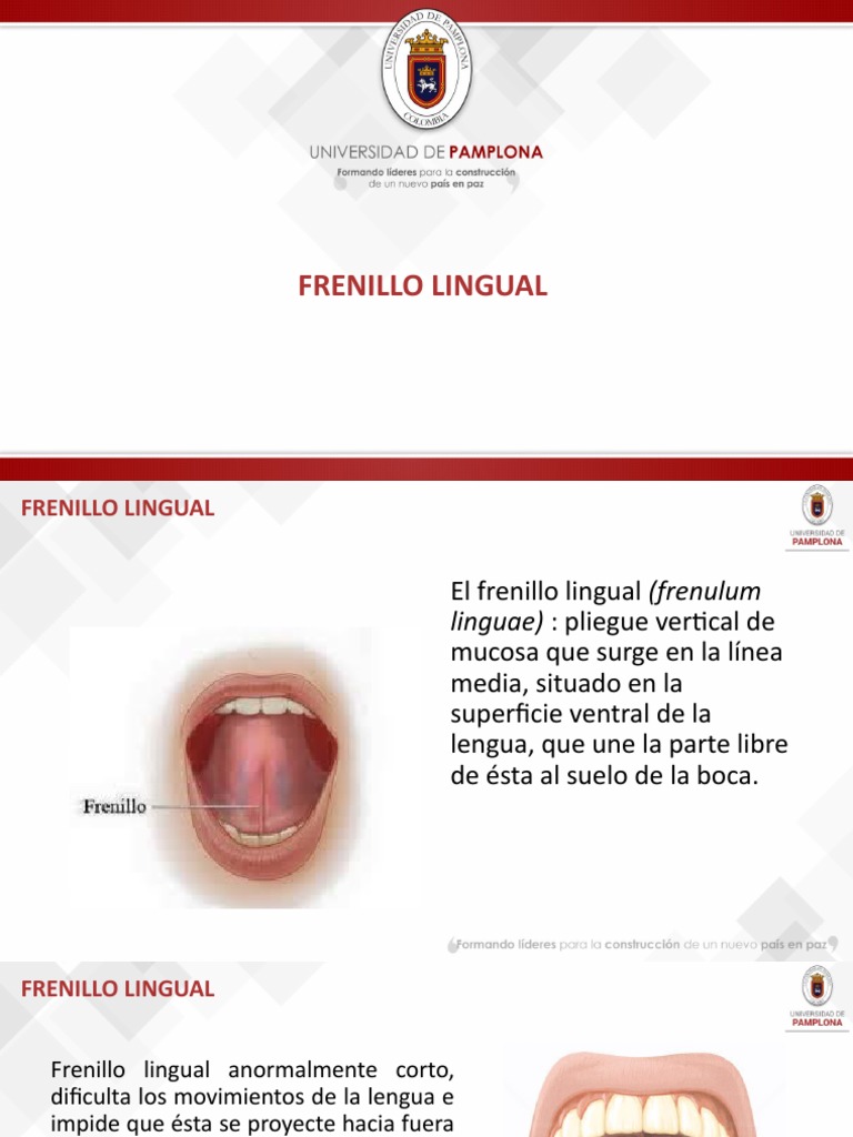 Frenillo Lingual | PDF | Pecho | Lengua