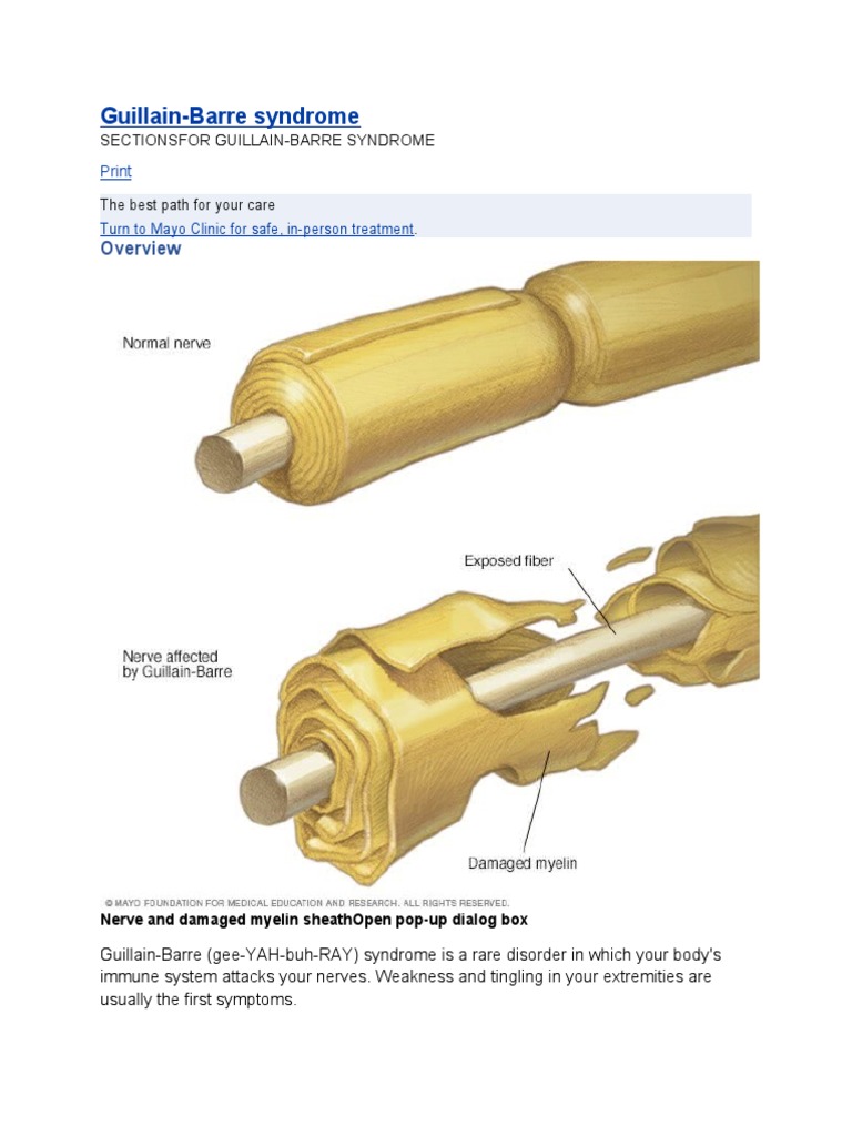 Understanding Guillain-Barre Syndrome | PDF | Electromyography ...
