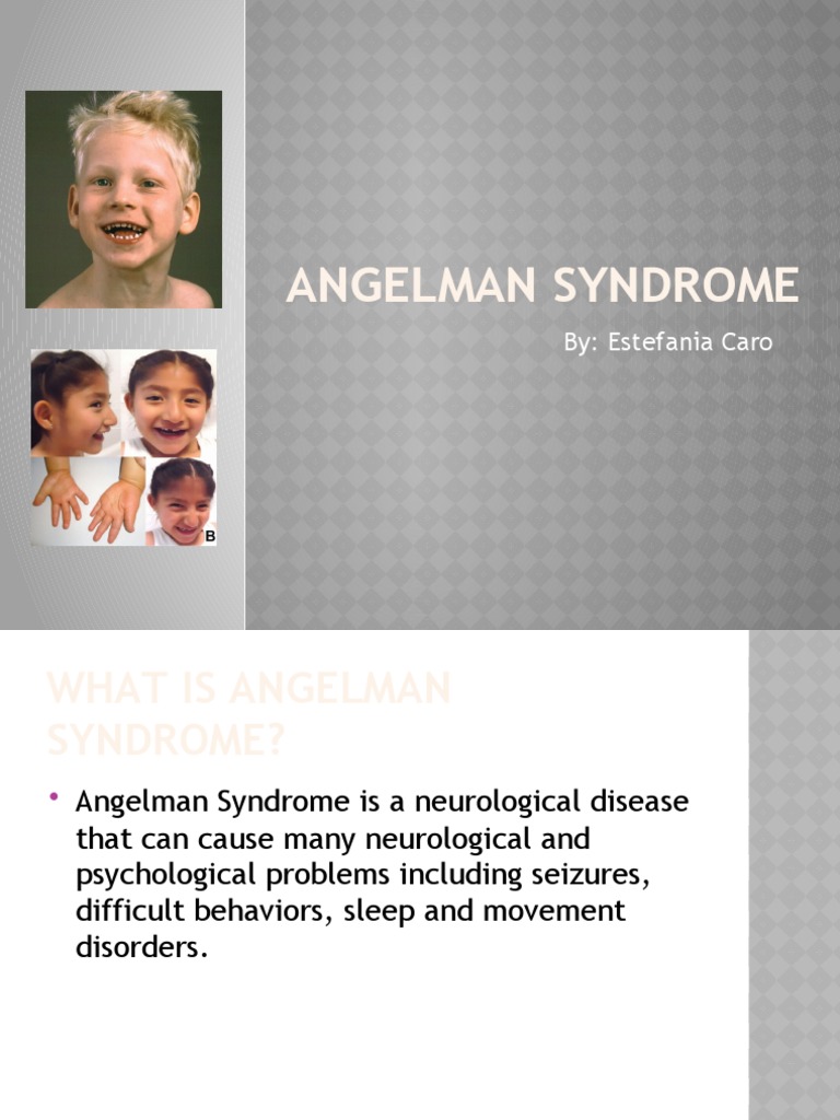 Angelman Syndrome | PDF | Human Diseases And Disorders | Diseases And ...