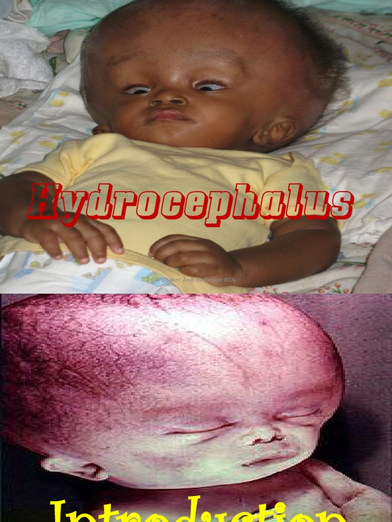 Hydrocephalus and Head Injury ...... | PDF | Traumatic Brain Injury ...