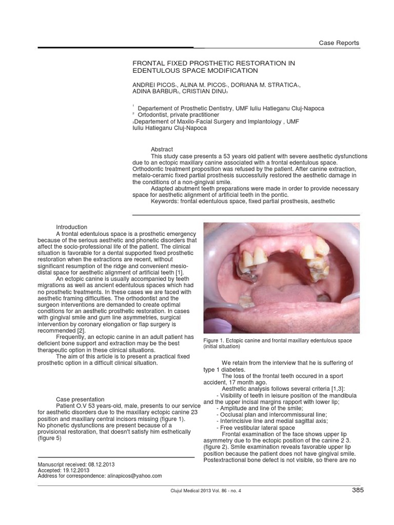 Frontal Fixed Prosthetic Restoration in Edentulous Space Modification ...