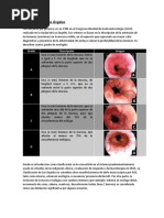 Incisión Rocky Davis | PDF | Medicina CLINICA | Anatomía