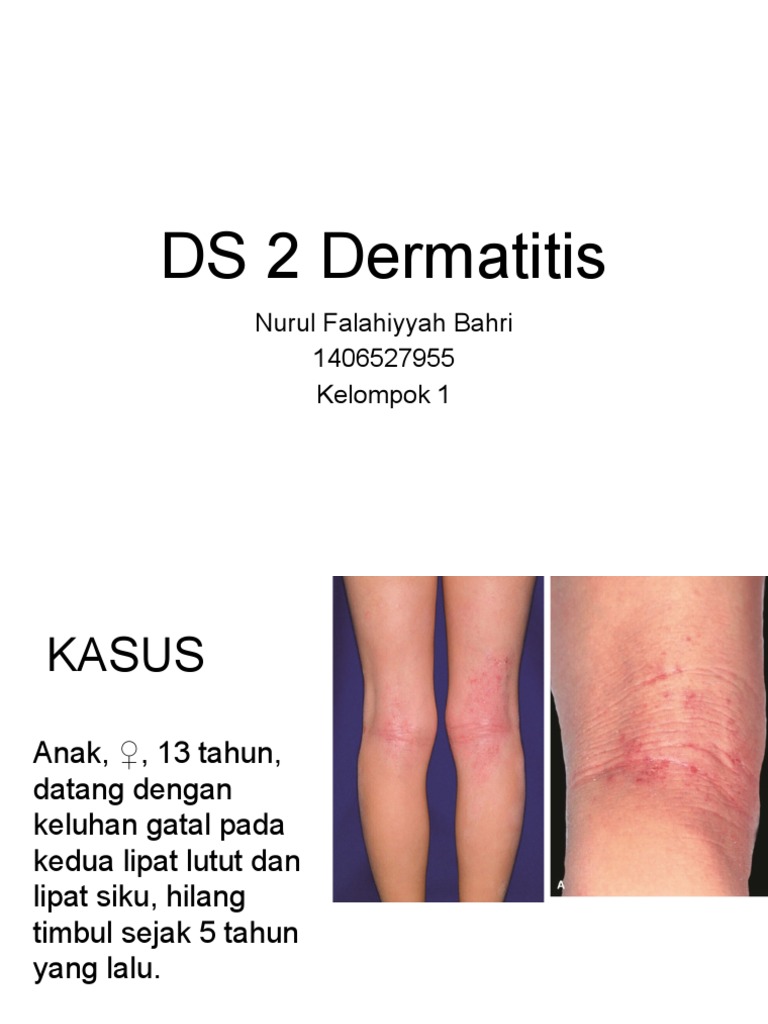 MENGENAL DERMATITIS ATOPIK PADA ANAK | PDF