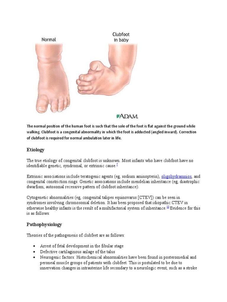 Clubfoot | PDF | Epidemiology | Congenital Disorder