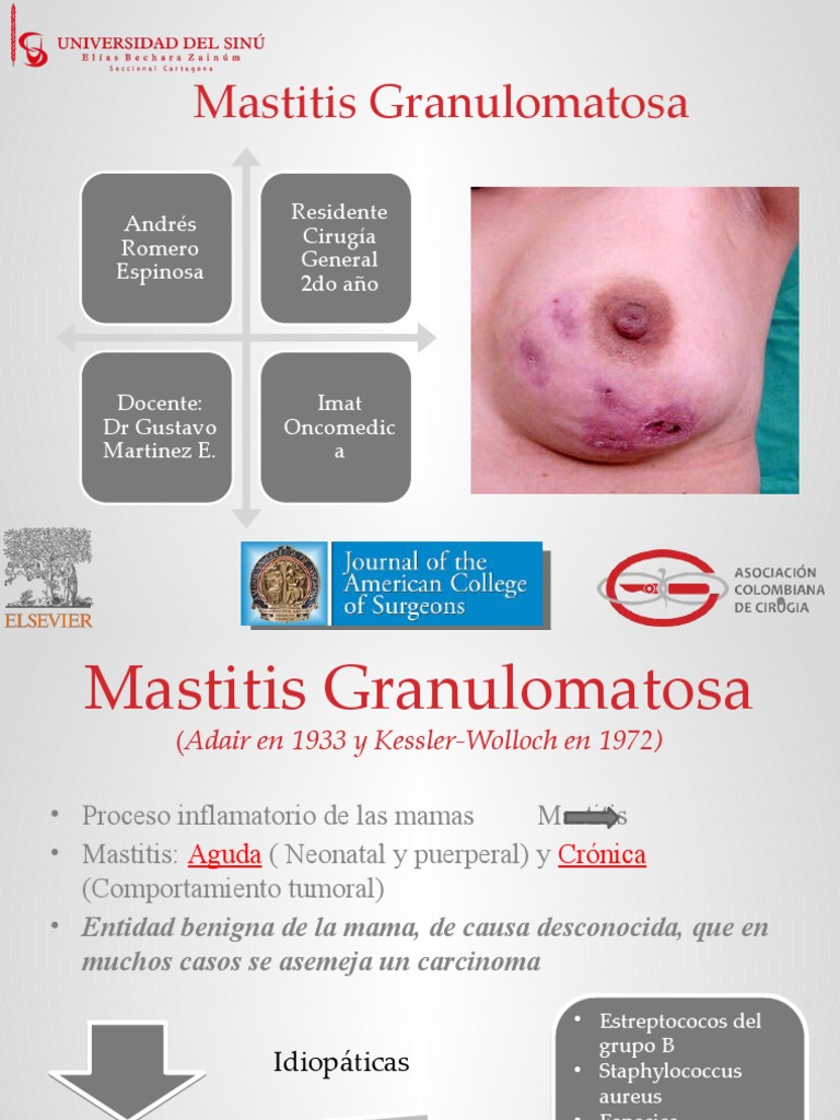 Mastitis Granulomatosa | Descargar gratis PDF | Cáncer de mama | Cáncer