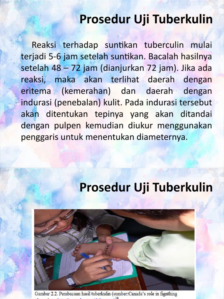 Prosedur Uji Tuberkulin | PDF